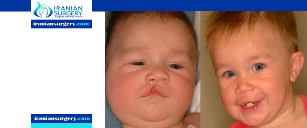 craniofacial surgery | Iranian Surgery