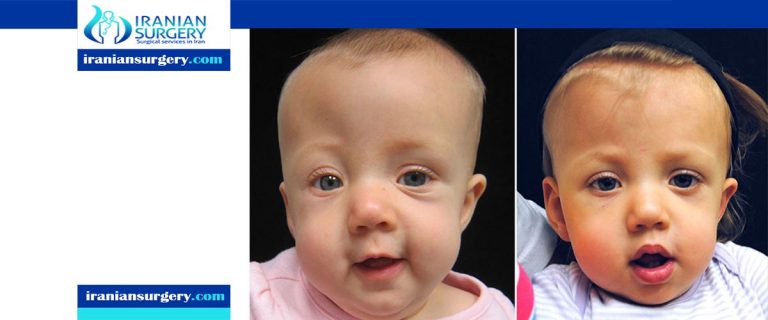 Craniosynostosis Treatment | Cost | Surgery | Risks | Iranian Surgery