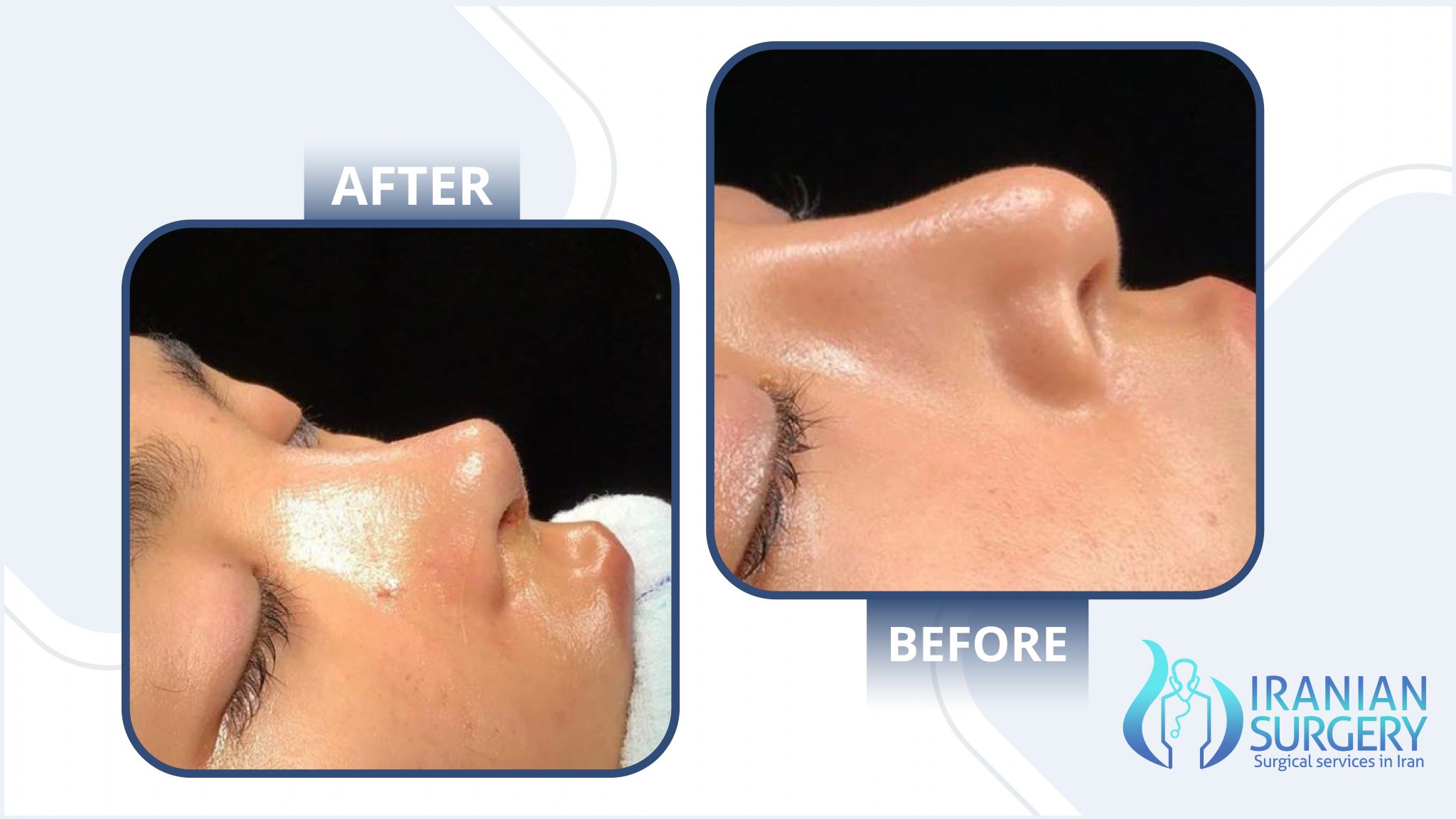 Rhinoplasty in Iran| Best Nose job Surgeon | Iranian surgery