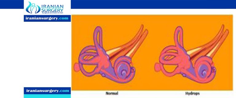 Endolymphatic hydrops Symptoms | Endolymphatic hydrops Prognosis