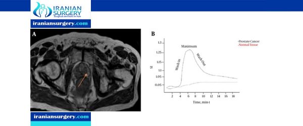 prostate needle biopsy recovery | prostate biopsy recovery time