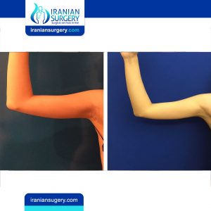 lipomatic before and after | liposuction before and after | Iranian Surgery