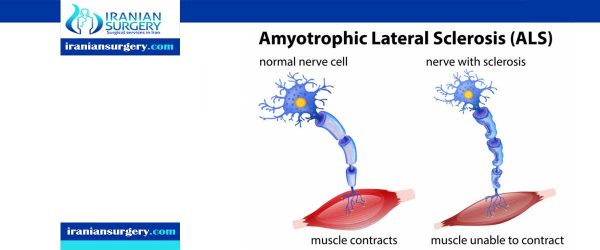 Amyotrophic Lateral Sclerosis - Iranian Surgery