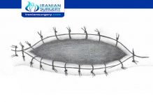 what to expect after marsupialization? | Stitches | marsupialization ...