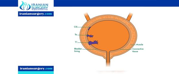 Bladder Cancer Staging - Iranian Surgery