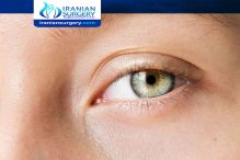 what to expect after dcr surgery | Before dacryocystorhinostomy surgery