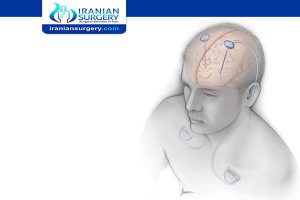 Deep Brain Stimulation Surgery | deep brain stimulation cost
