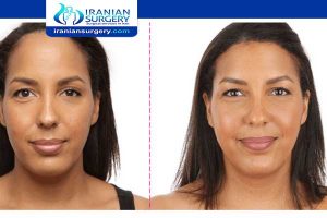 Forehead Reduction Without Surgery| Forehead Reduction|Iranian Surgery