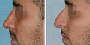 Iranian nose job pictures | Iranian nose job trend | Nose iranian style