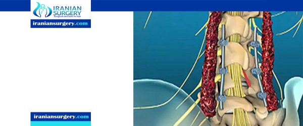 laminectomy procedure | laminectomy surgery procedure | Iranian Surgery