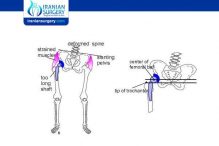 Leg Length Discrepancy Exercises | limb length discrepancy exercises
