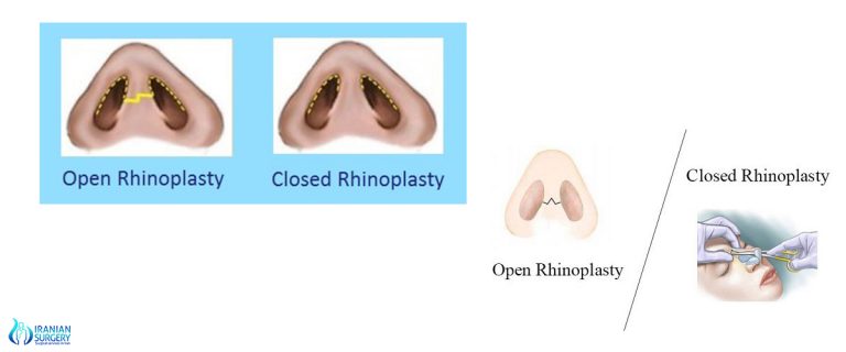 open vs closed rhinoplasty|open rhinoplasty vs closed risks|Iranian Surgery