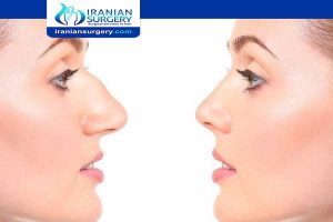 Rhinoplasty healing stages | Rhinoplasty swelling stages | week by week