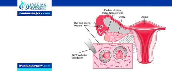 Zift Meaning What Is ZIFT Technique Iranian Surgery zift-meaning-what-is-zift-technique-iranian-surgery