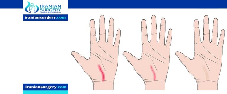 Wrist Surgery Scar - Iranian Surgery