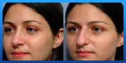 Nose job in Iran | Rhinoplasty Surgeon Iran | Best Hospital | Iranian ...
