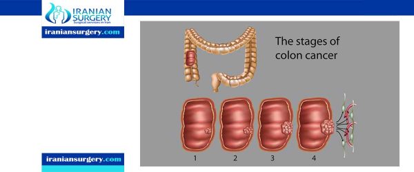 Surgery for early-stage colon cancer - Surgery for advanced colon cancer