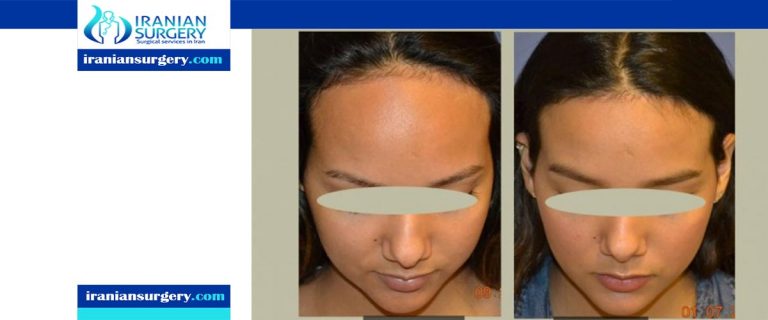 Forehead reduction surgery | Hairline lowering surgery | Iranian Surgery
