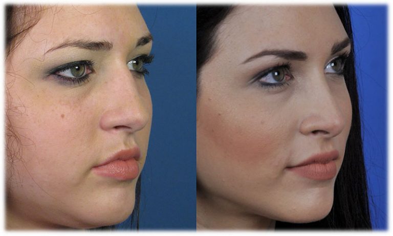 Rhinoplasty in Iran| Best Nose job Surgeon | Iranian surgery