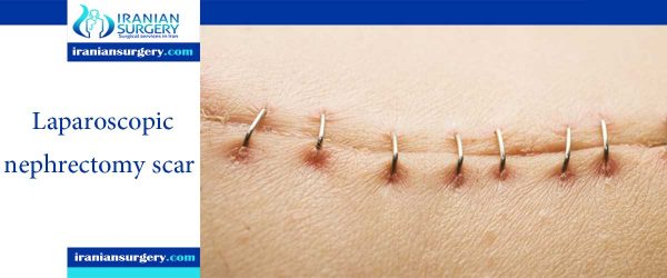 laparoscopic nephrectomy scar - Iranian Surgery