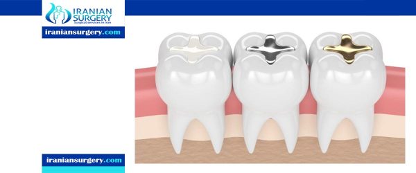 Permanent Tooth Filling | Permanent Filling Material | Iranian Surgery