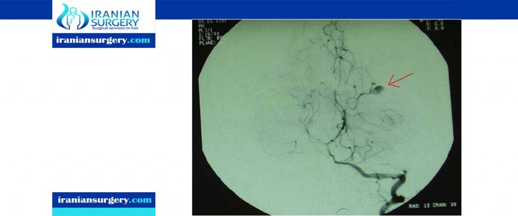 Transmyocardial laser revascularization | Iranian Surgery
