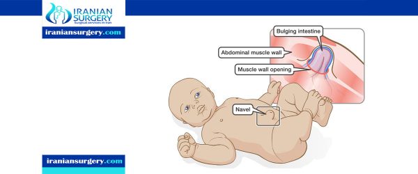 What is hernia surgery - Iranian Surgery